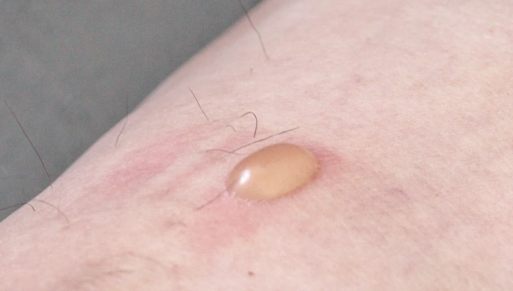 25 Causes of Raised Skin Bumps (with Pictures) – Dtclinis