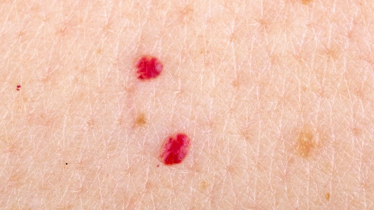 25 Causes of Raised Skin Bumps (with Pictures) – Dtclinis